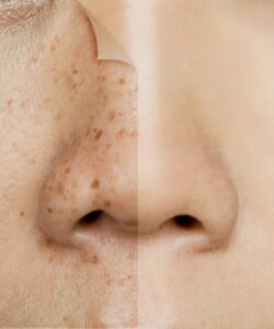 Seboreik Keratoz Bahçeşehir | Naturaslim